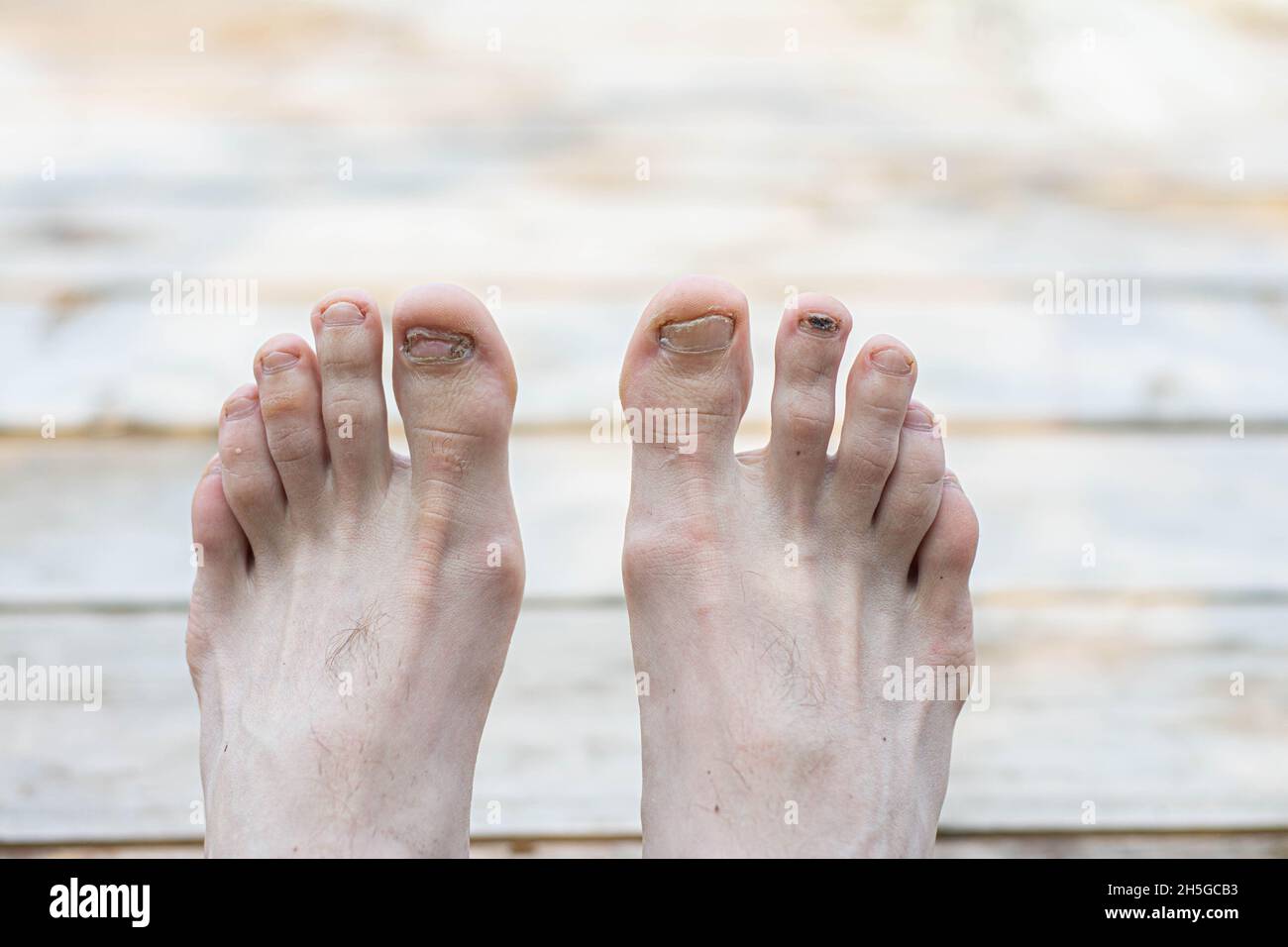 injury of a blackened chipped toenail in a man treatment and prevention ...