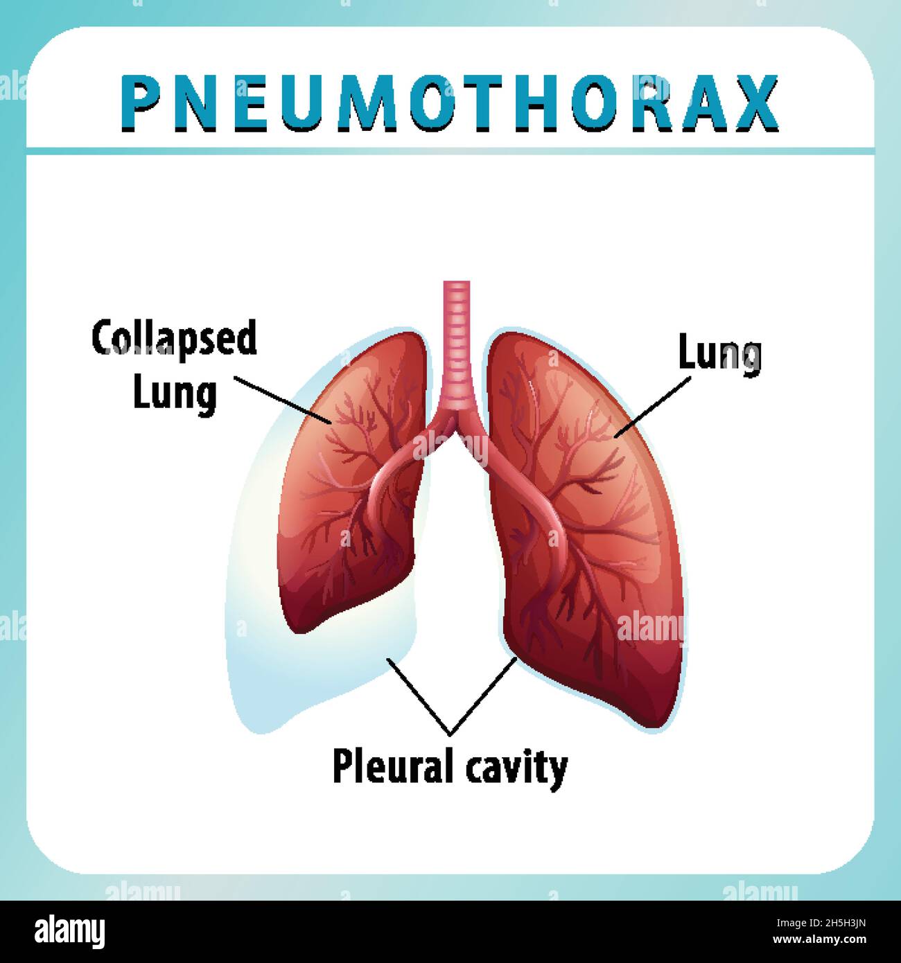 Pneumothorax diagram with collapsed lung and healthy lung illustration ...