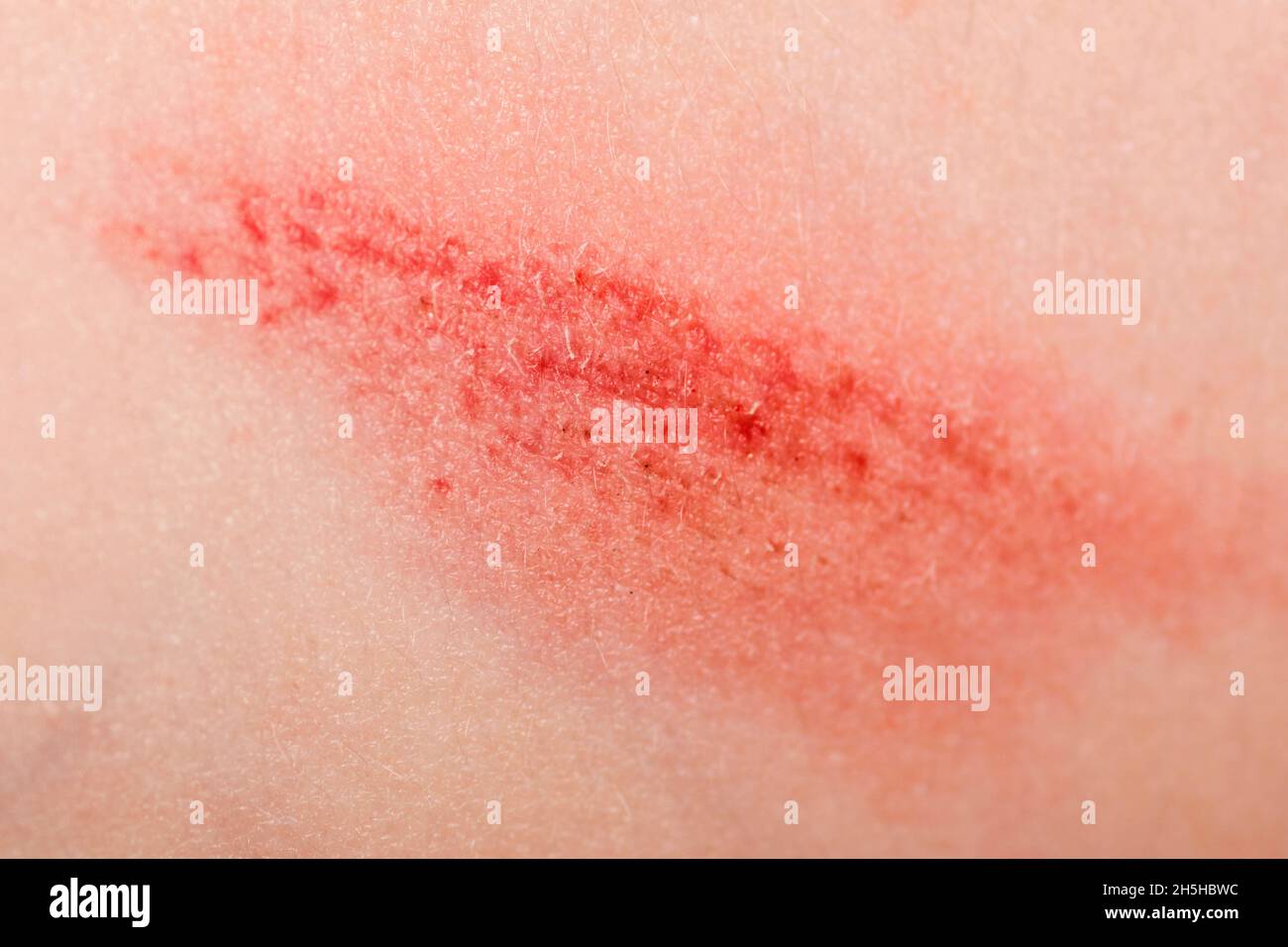A wound on the human body. Very close up of painful wound Stock Photo ...