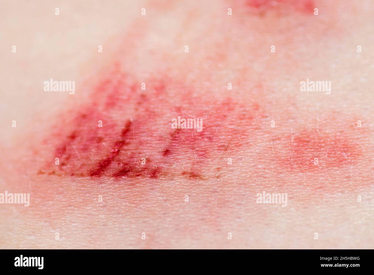 A wound on the human body. Very close up of painful wound Stock Photo ...