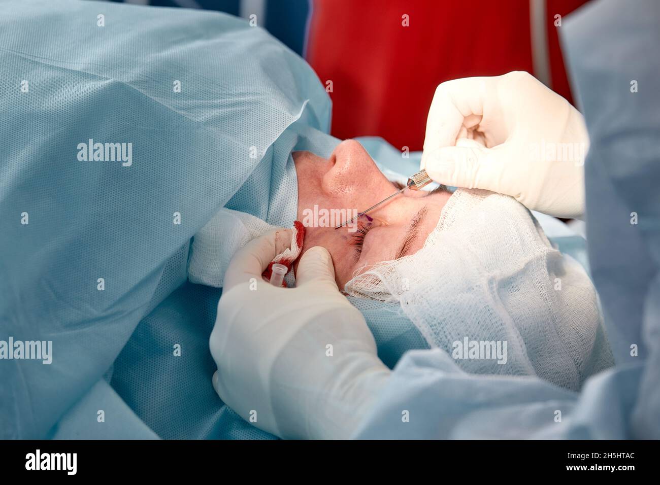 Close up of the face of a patient who is undergoing blepharoplasty. The ...