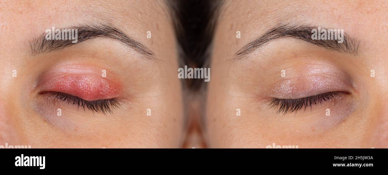 Chalazion abscess hi-res stock photography and images - Alamy