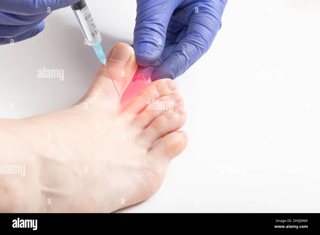 The doctor makes an injection between the toes against hyperhidrosis ...