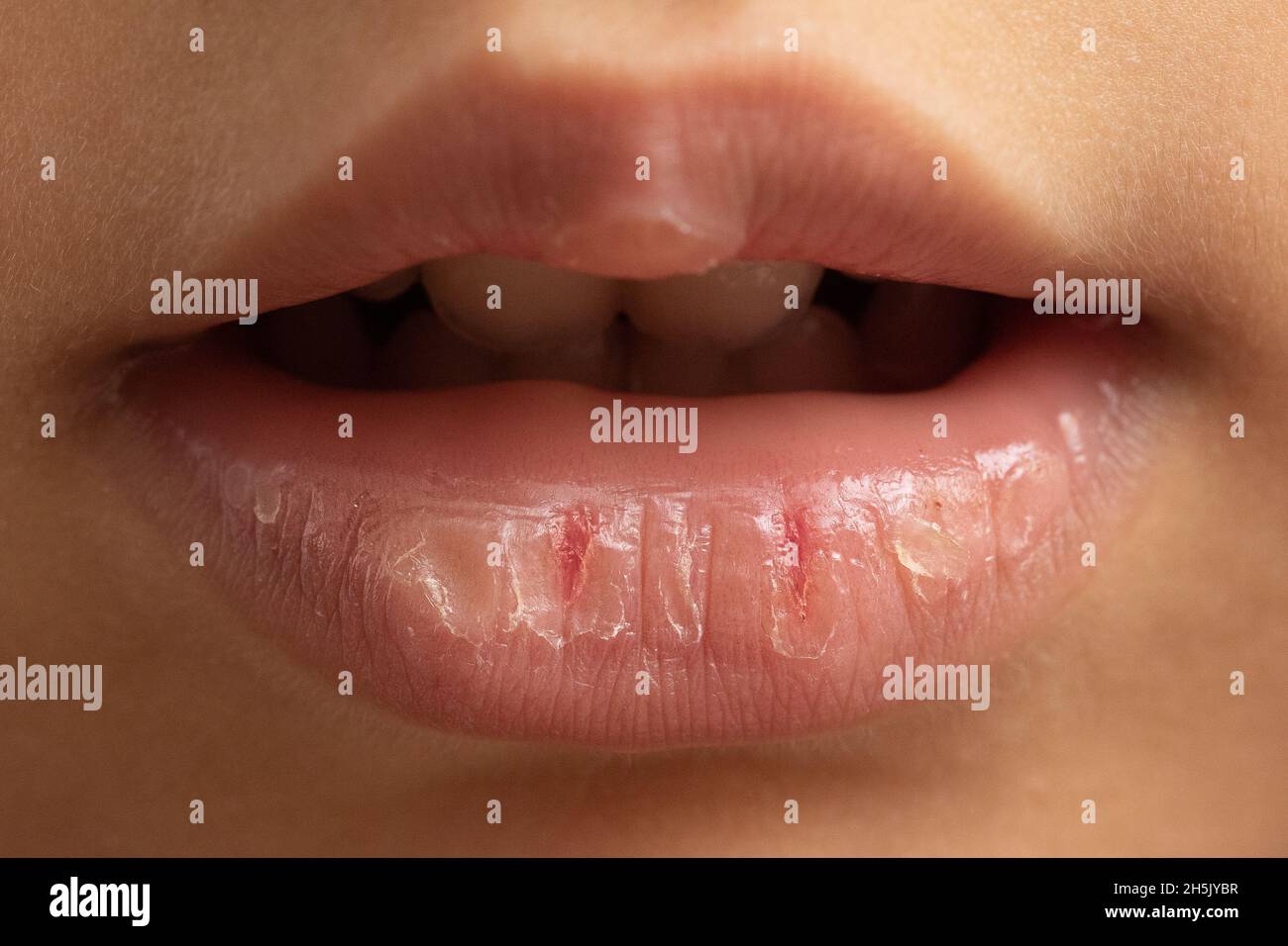 A little girl's chapped lips due to cold and dehydration Stock Photo ...