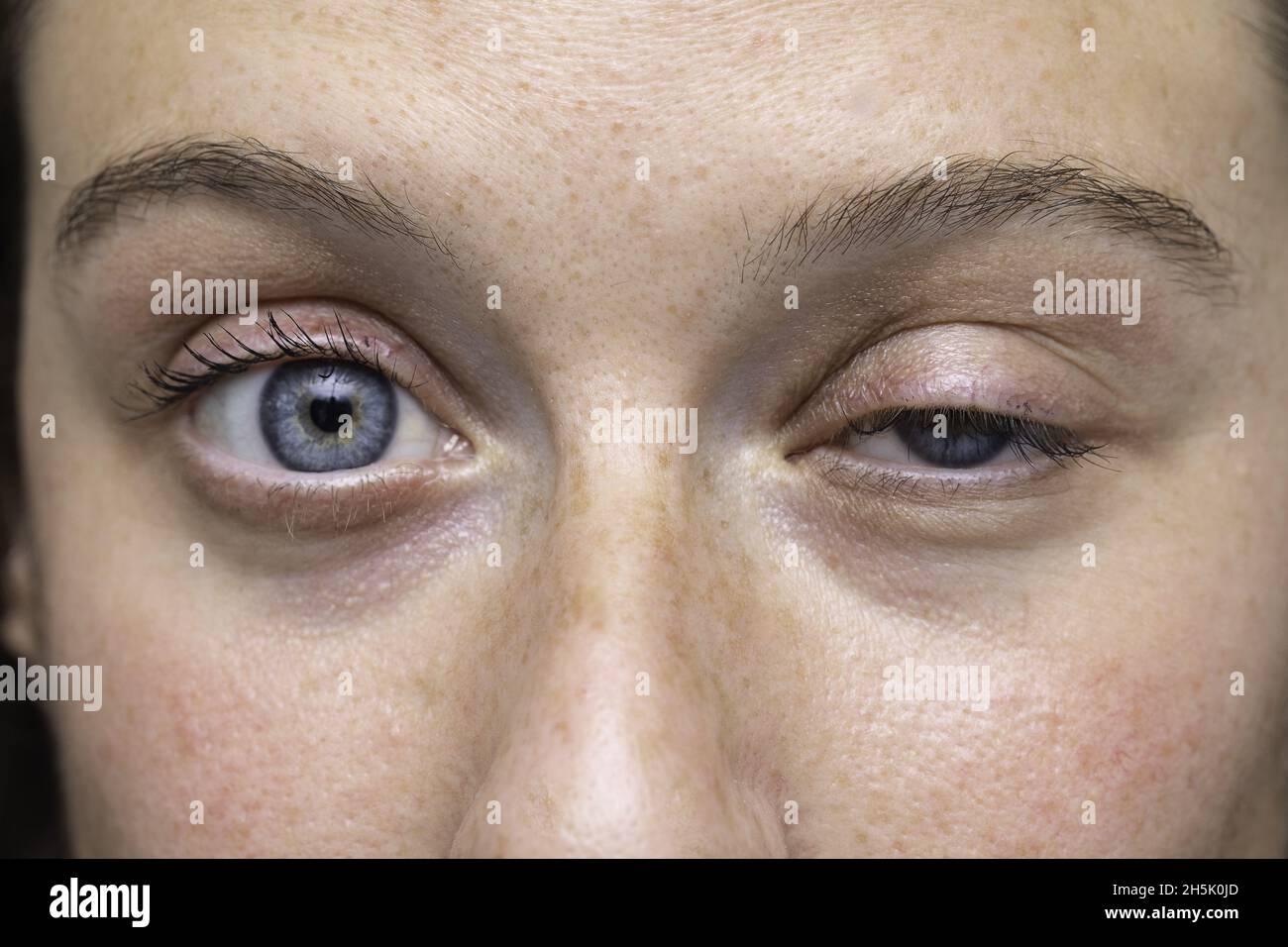 Close up of eyes of girl with lazy eyelid syndrome Stock Photo - Alamy