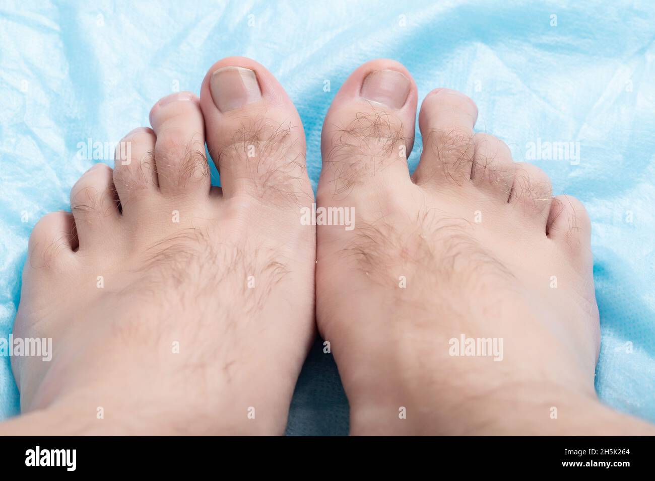 Hairiness on the toes of a person, close-up. Hygiene and cosmetology ...