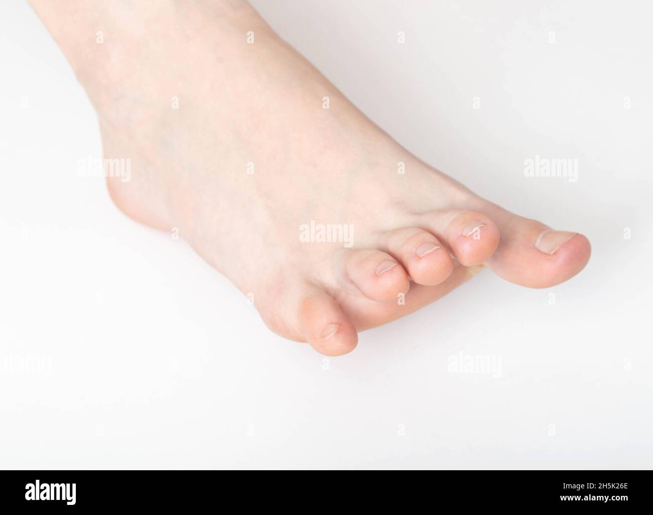The girl's crooked toes, close-up. Aesthetic defect, crooked toe ...