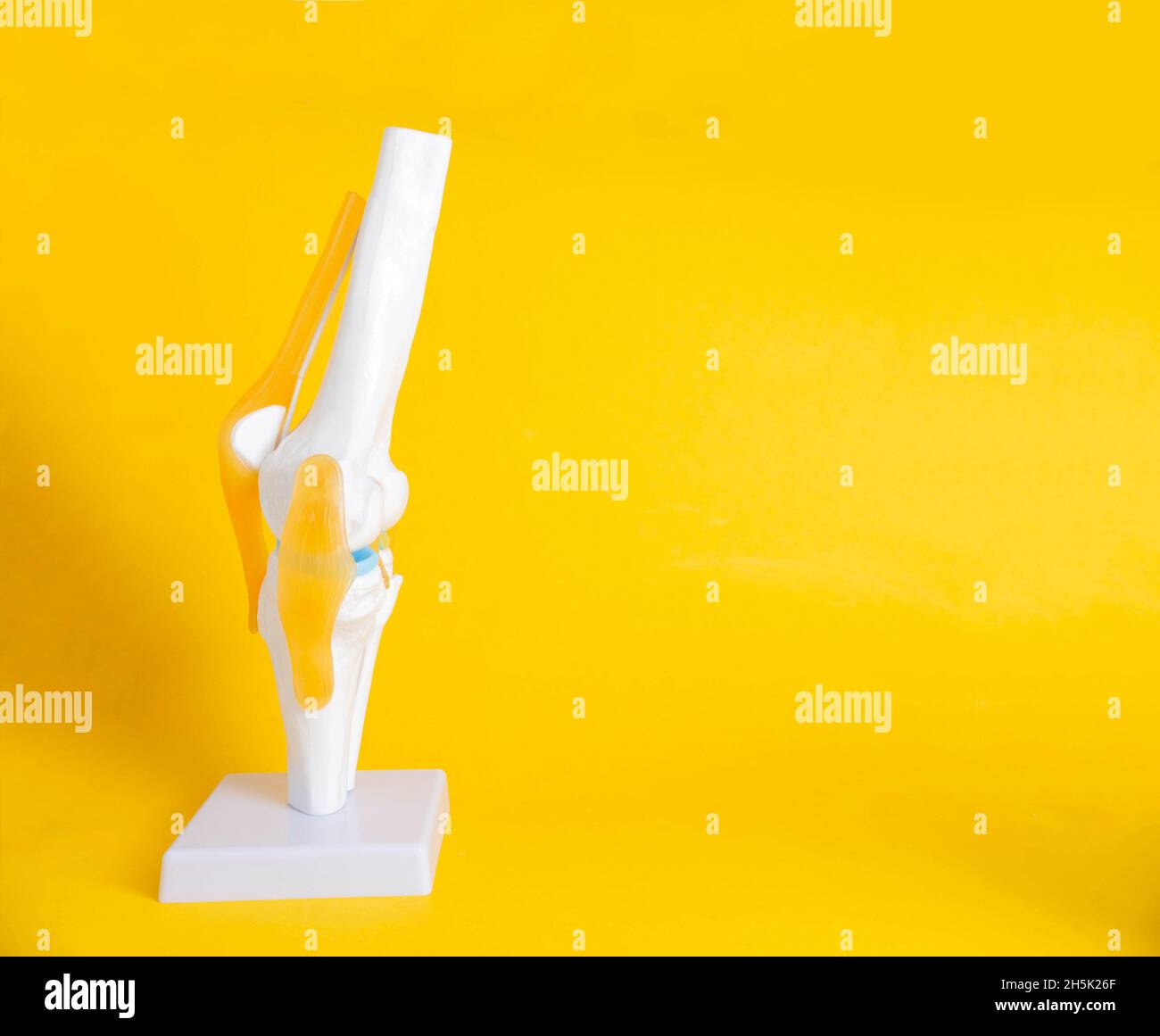 Knee joint mockup on yellow background. Concept of knee arthroplasty ...