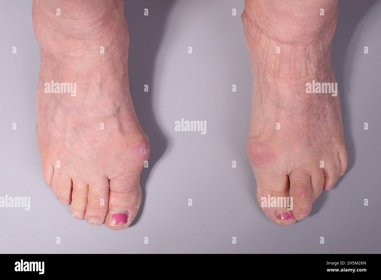 Foot pain elderly woman hi-res stock photography and images - Alamy