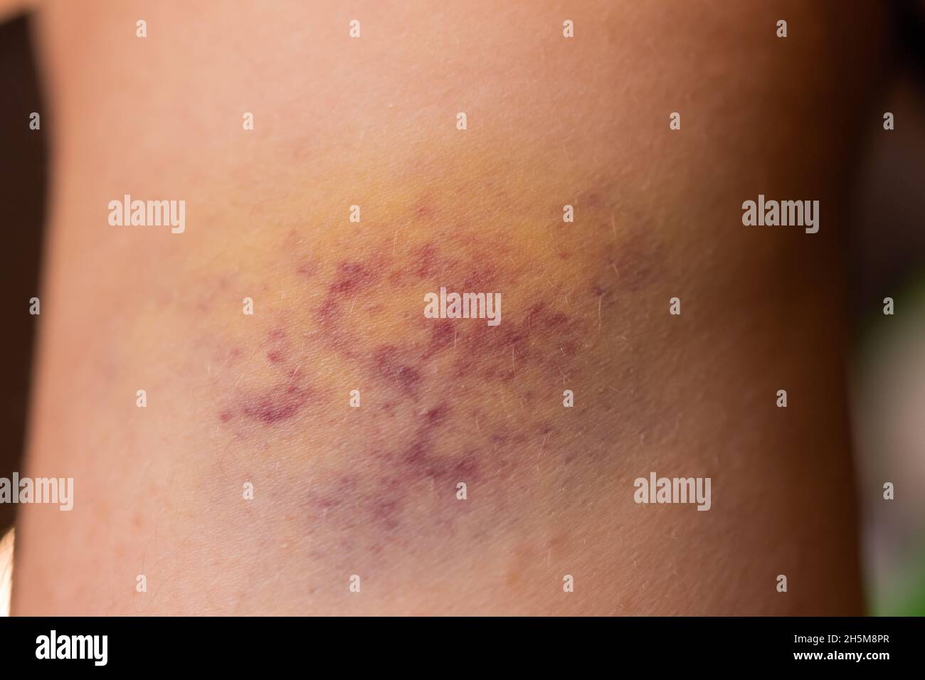 Bruise on skin womans hi-res stock photography and images - Alamy