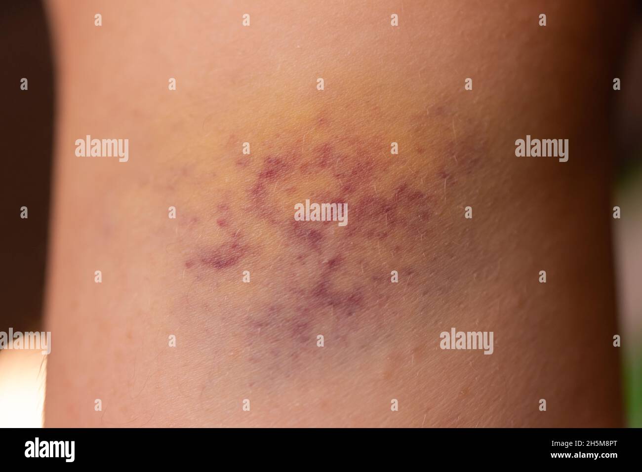 Subcutaneous blood vessels hi-res stock photography and images - Alamy