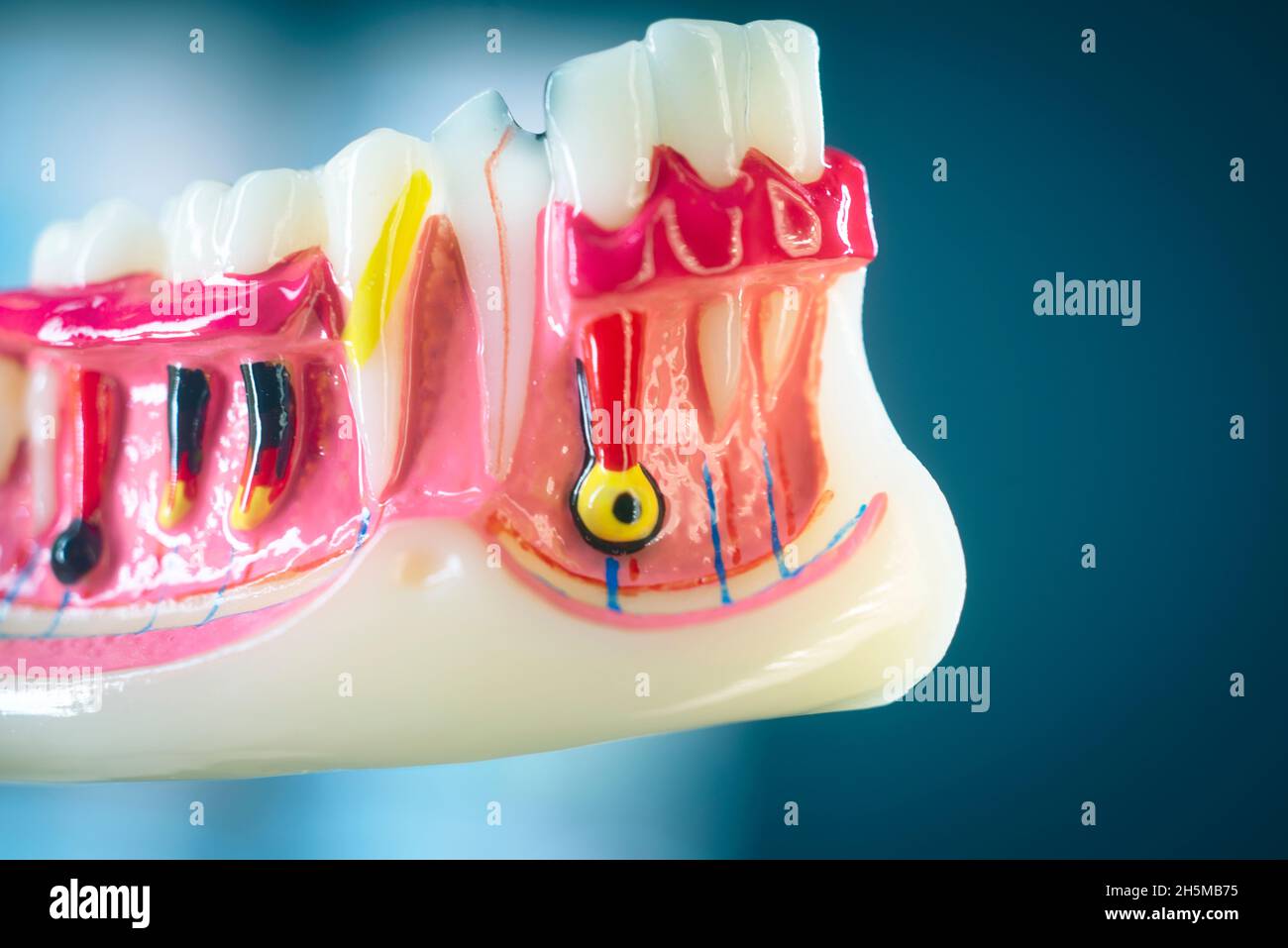 Tooth decay dentists dental model of teeth, gums and root canal Stock ...