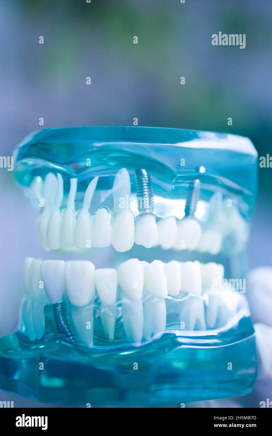 Dental tooth implant titanium prosthetic dentists model Stock Photo - Alamy