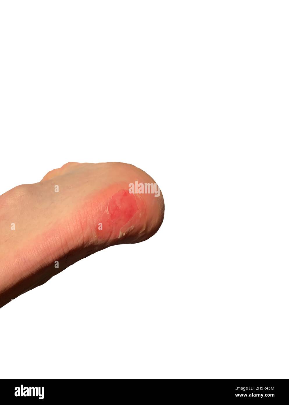 Sore open blister on the heel Stock Photo - Alamy