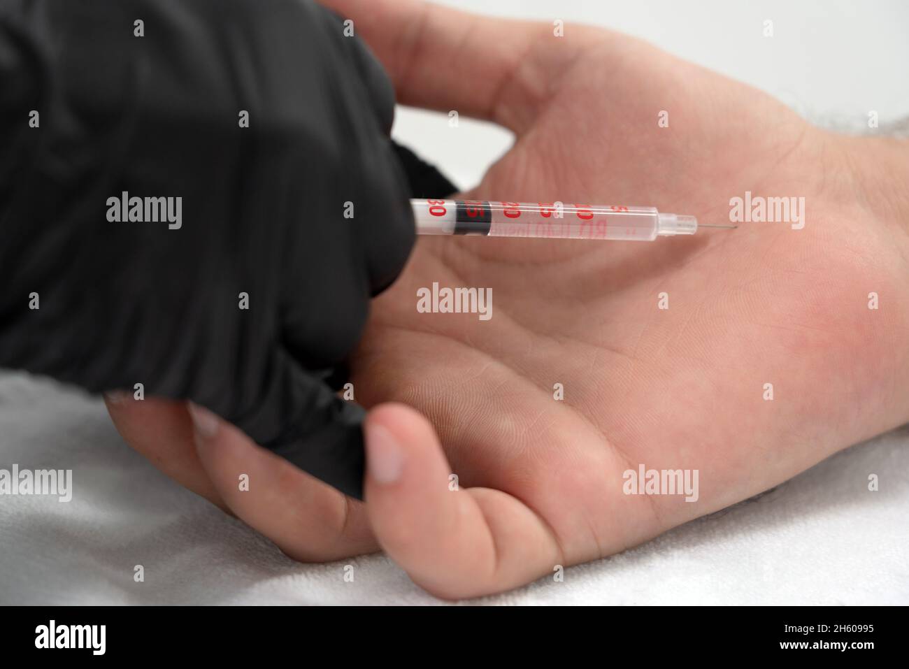 doctor makes a shot of botulinum toxin in the hand of a male palm ...