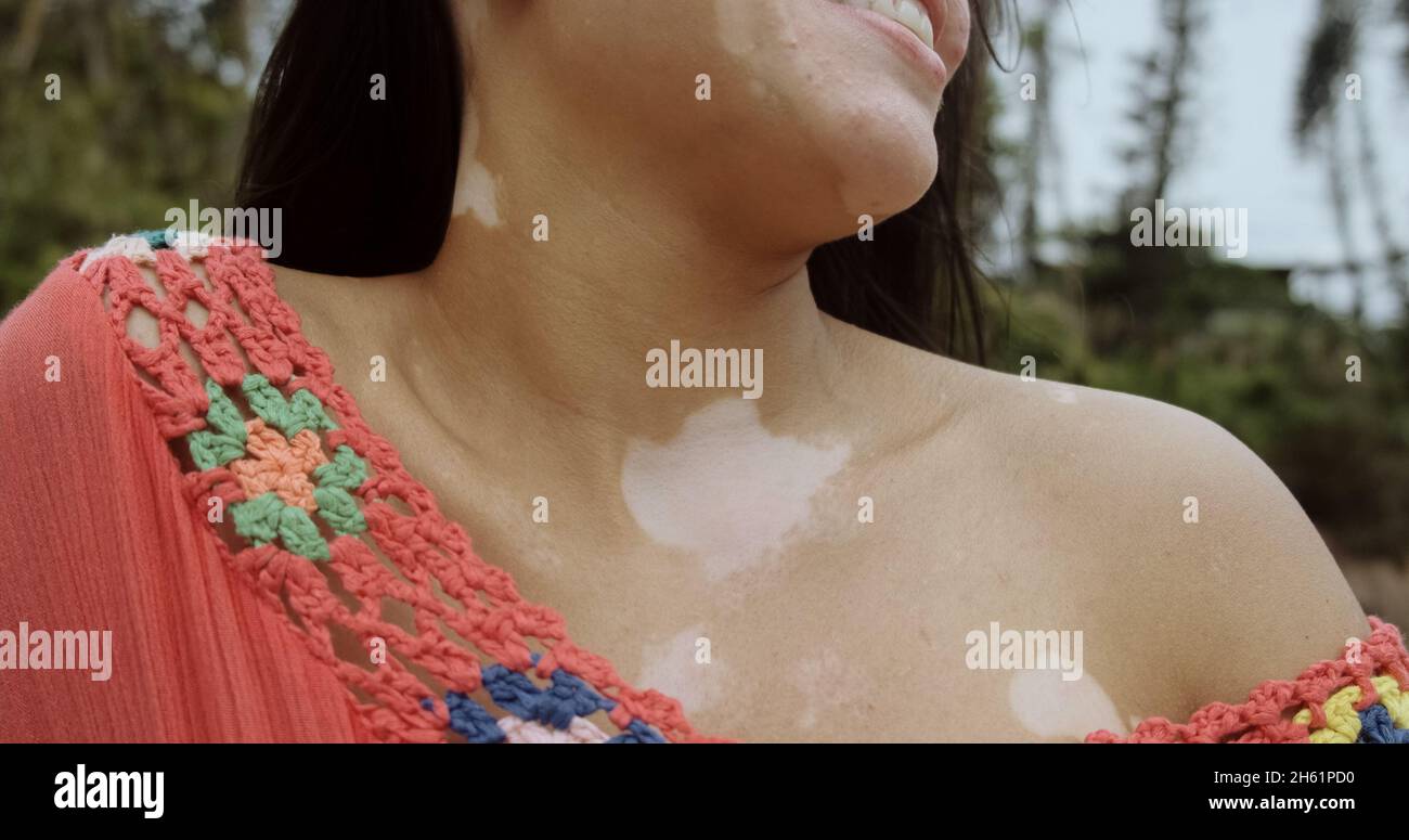 Girl with vitiligo hi-res stock photography and images - Alamy