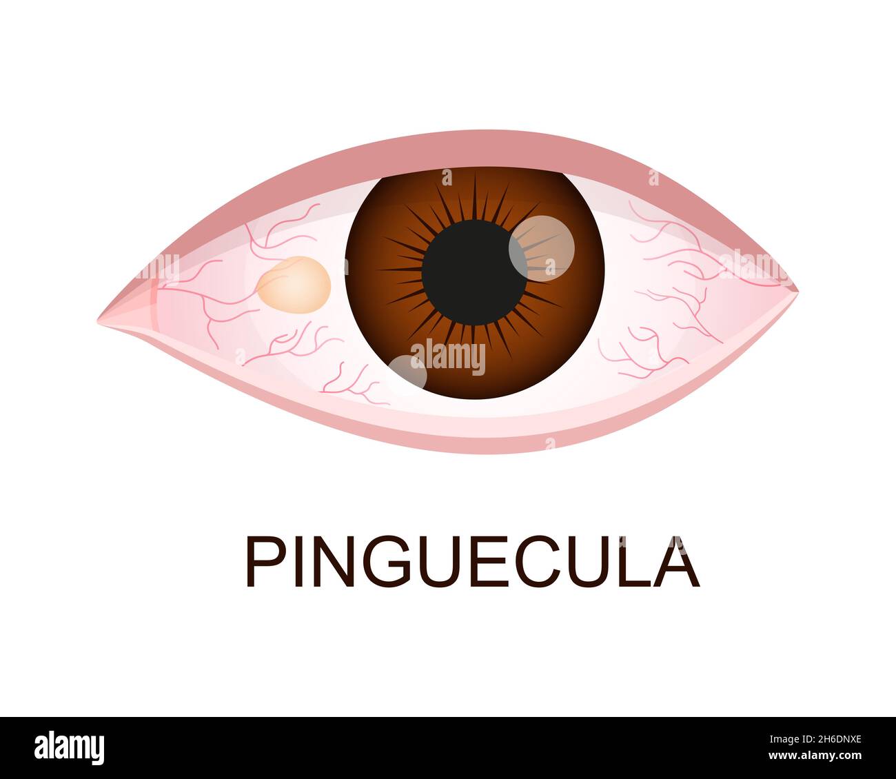 Pinguecula