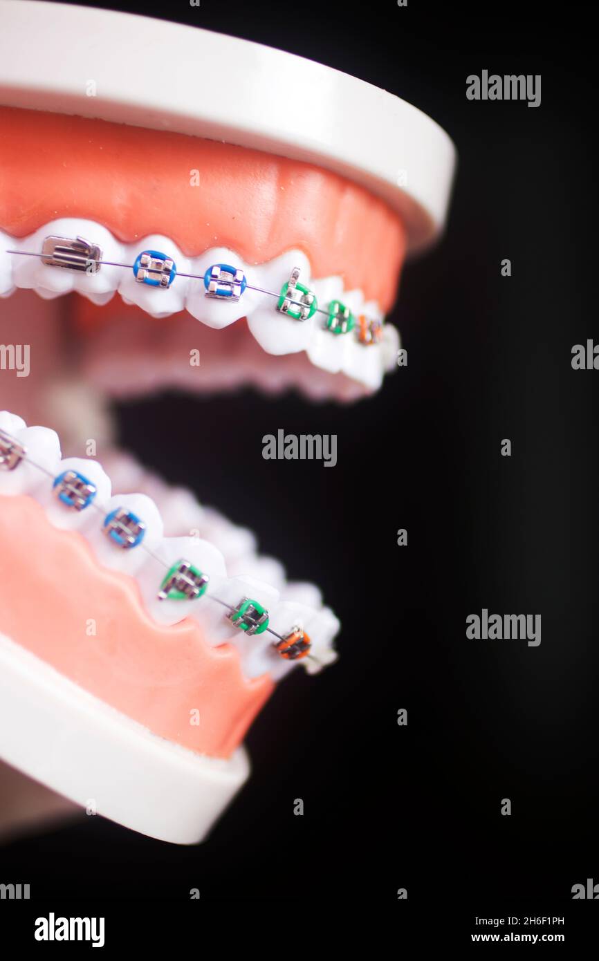 Dental teeth aligner bracket teaching student model showing gums and ...