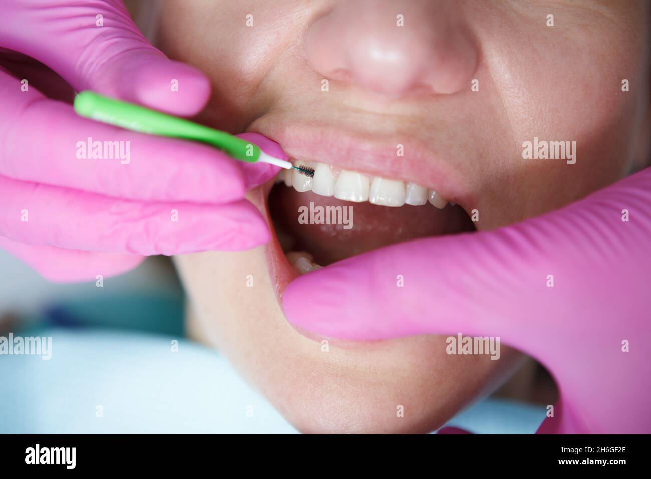Cropped close up of dentist using interdental toothbrush cleaning ...