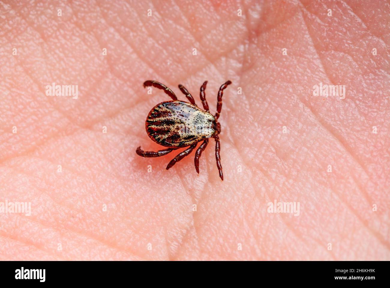 Infectious Encephalitis Tick Insect on Skin. Encephalitis Virus or Lyme ...