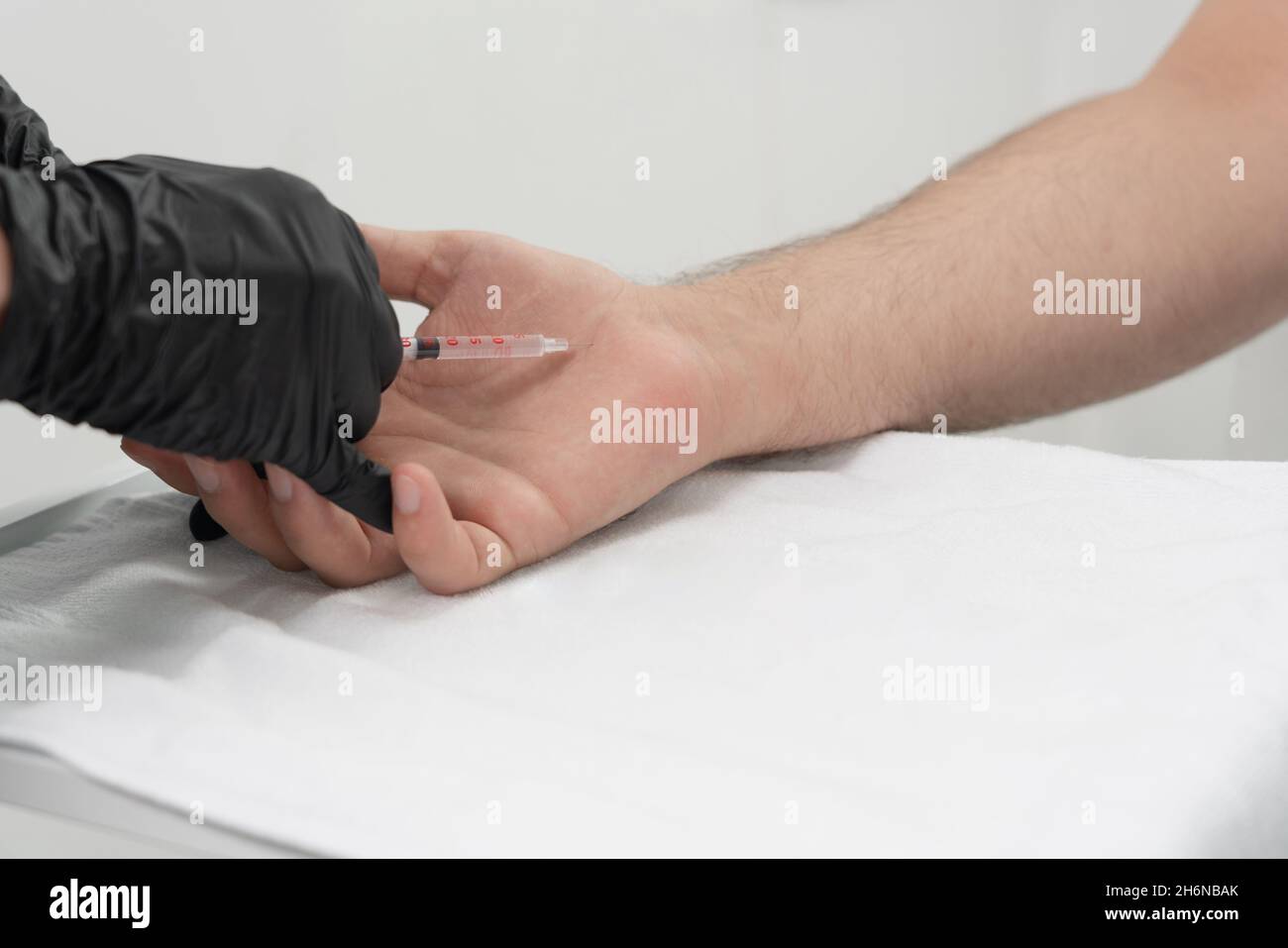 doctor makes a shot of botulinum toxin in the hand of a male palm ...