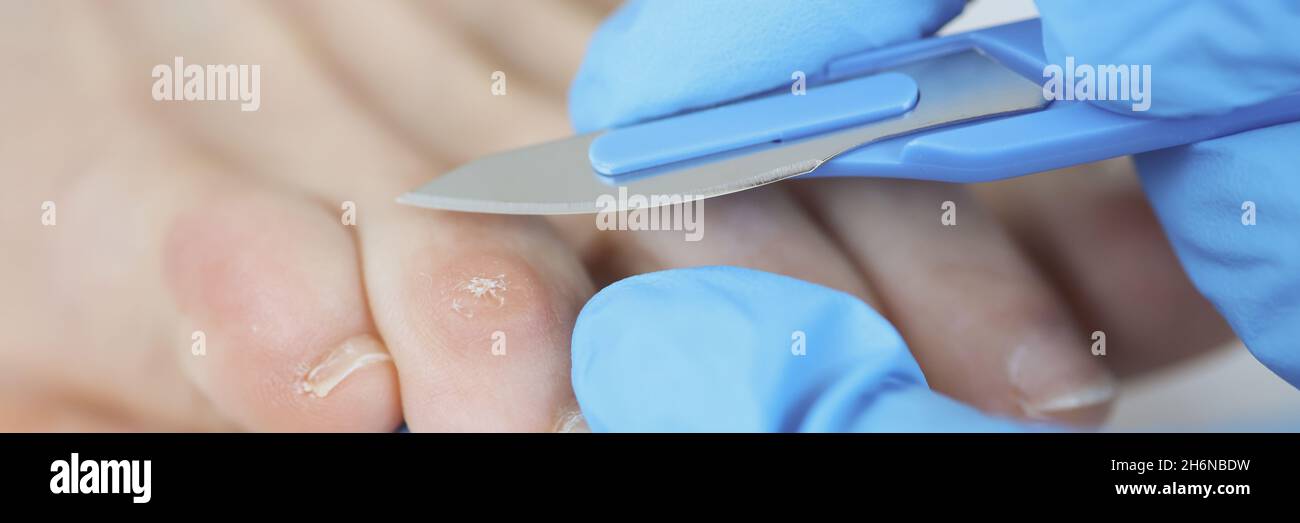 Doctor surgeon in rubber glove removing dry callus on toe with scalpel ...