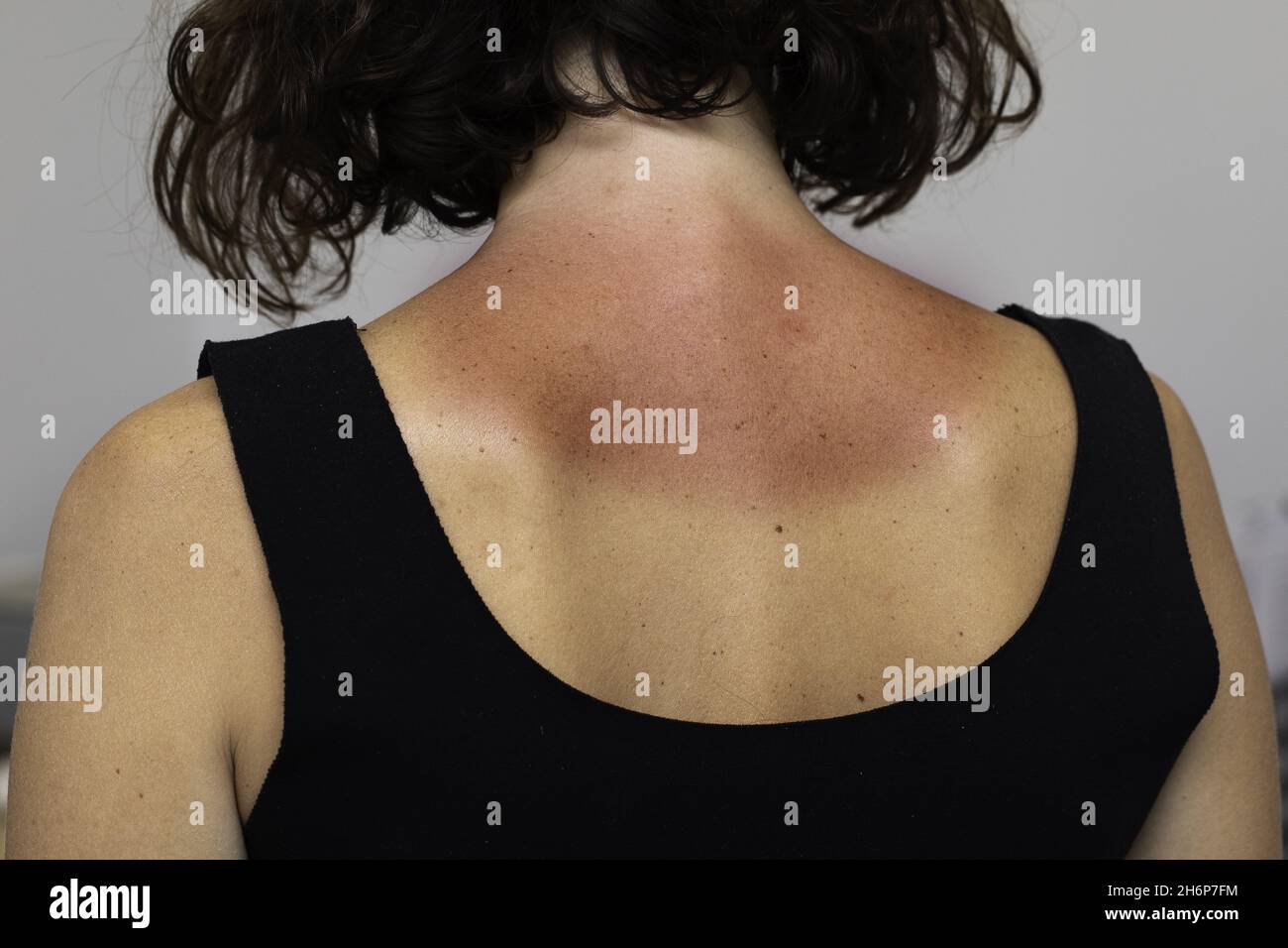 Girl With Sunburned Back Redness In The Areas Of Skin Uncovered By The