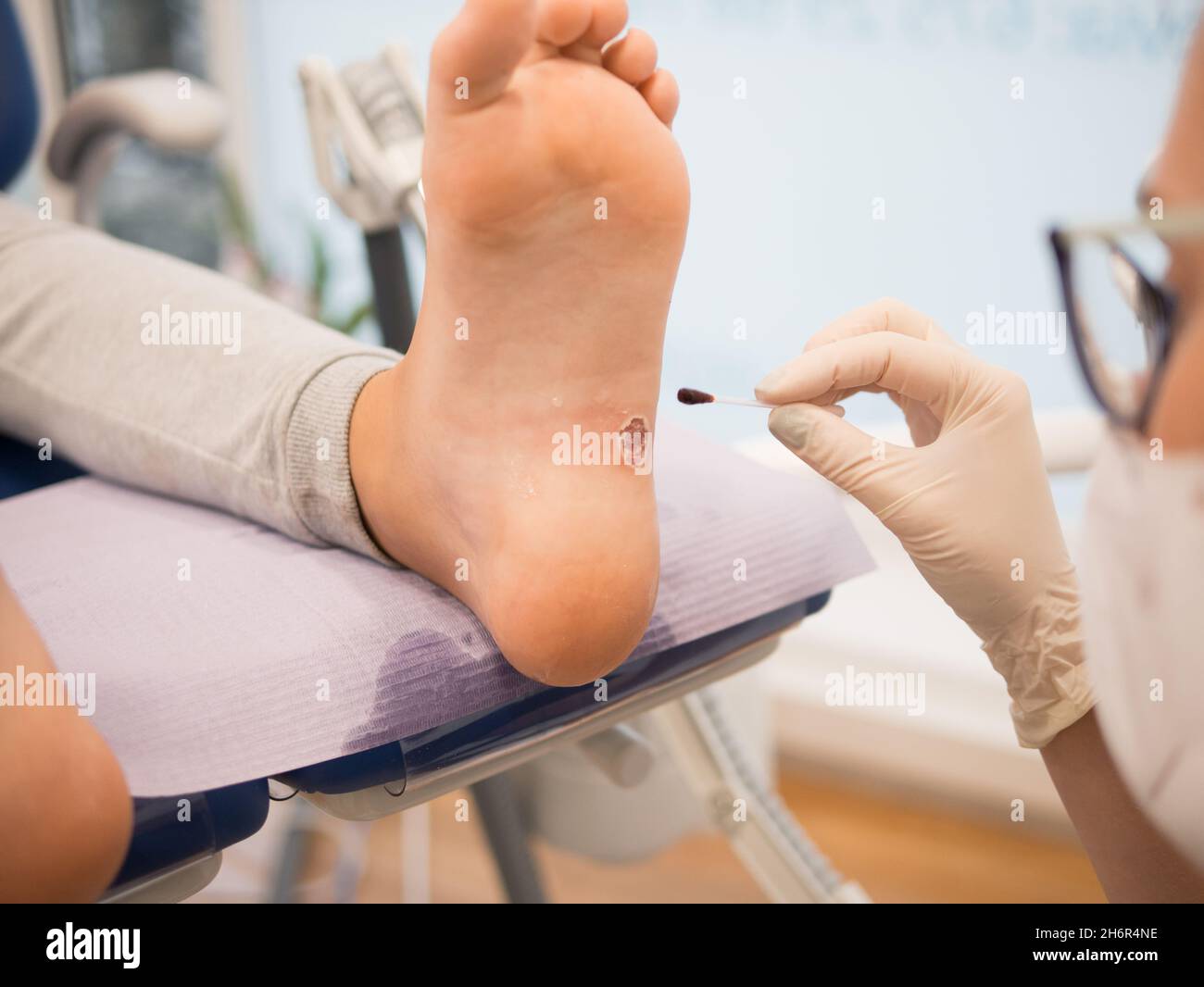 Verruca feet woman hi-res stock photography and images - Alamy