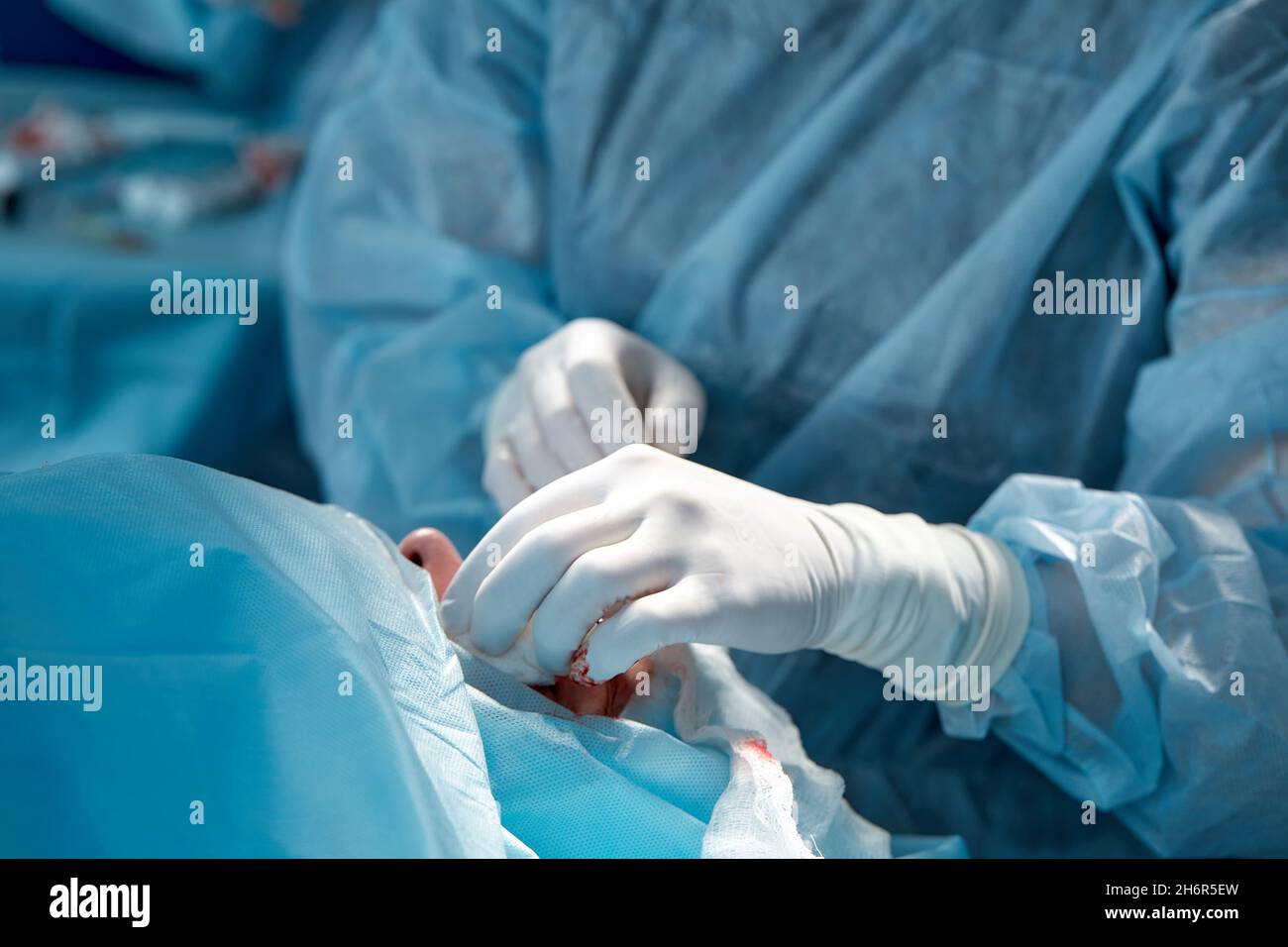 Close up of the face of a patient who is undergoing blepharoplasty. The ...