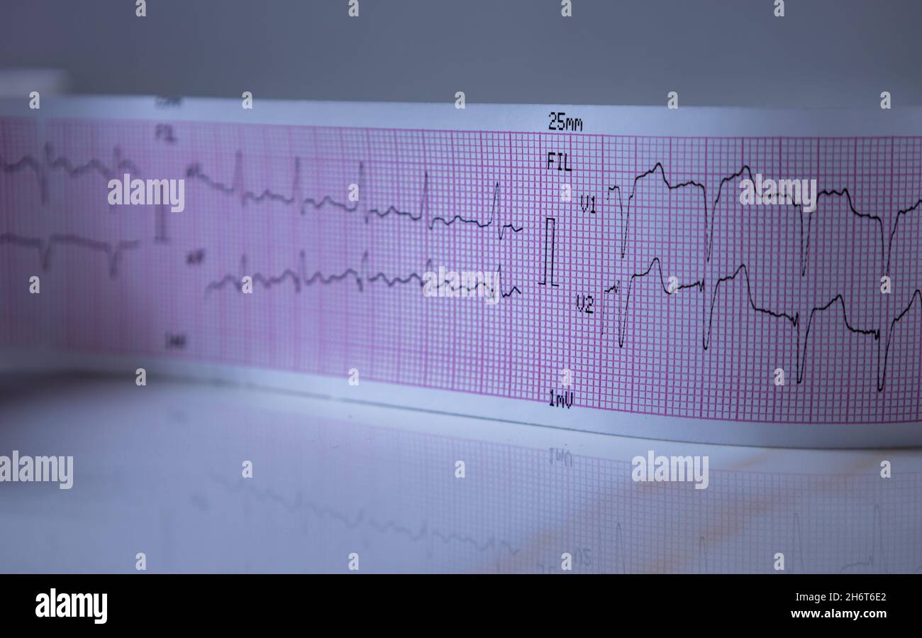 Electrocardiogram graph ekg heart rhythm hi-res stock photography and ...