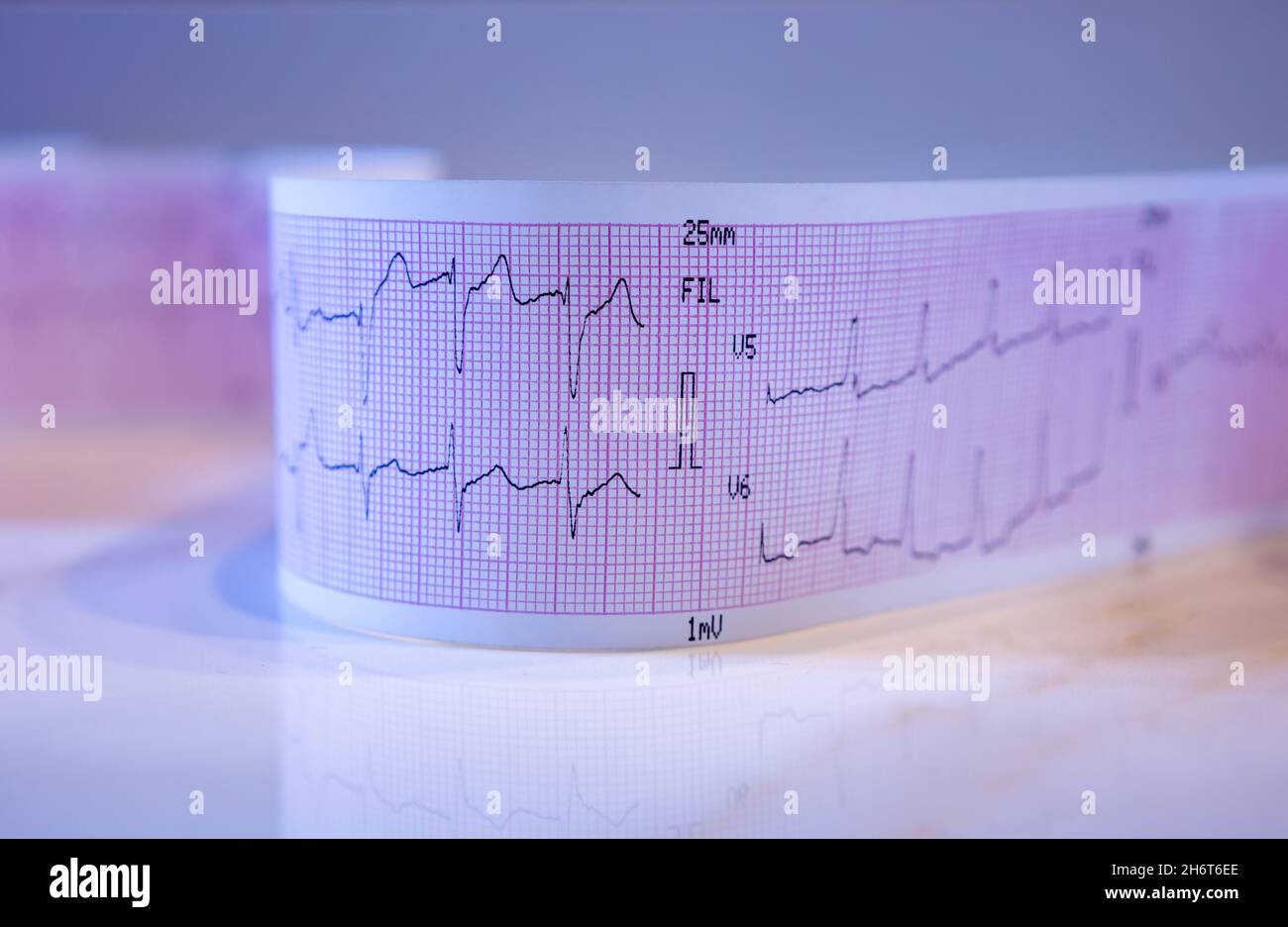 Rhythm strip atrial fibrillation hi-res stock photography and images ...