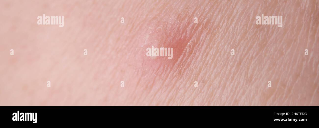 Boil on face hi-res stock photography and images - Alamy