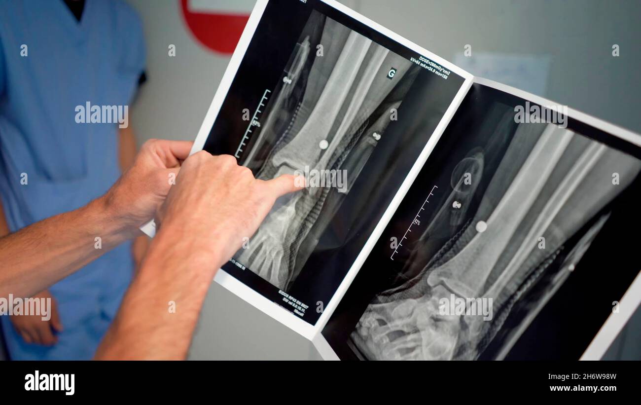 close-up of a doctor's or surgeon's hand pointing to a patient's x-ray ...