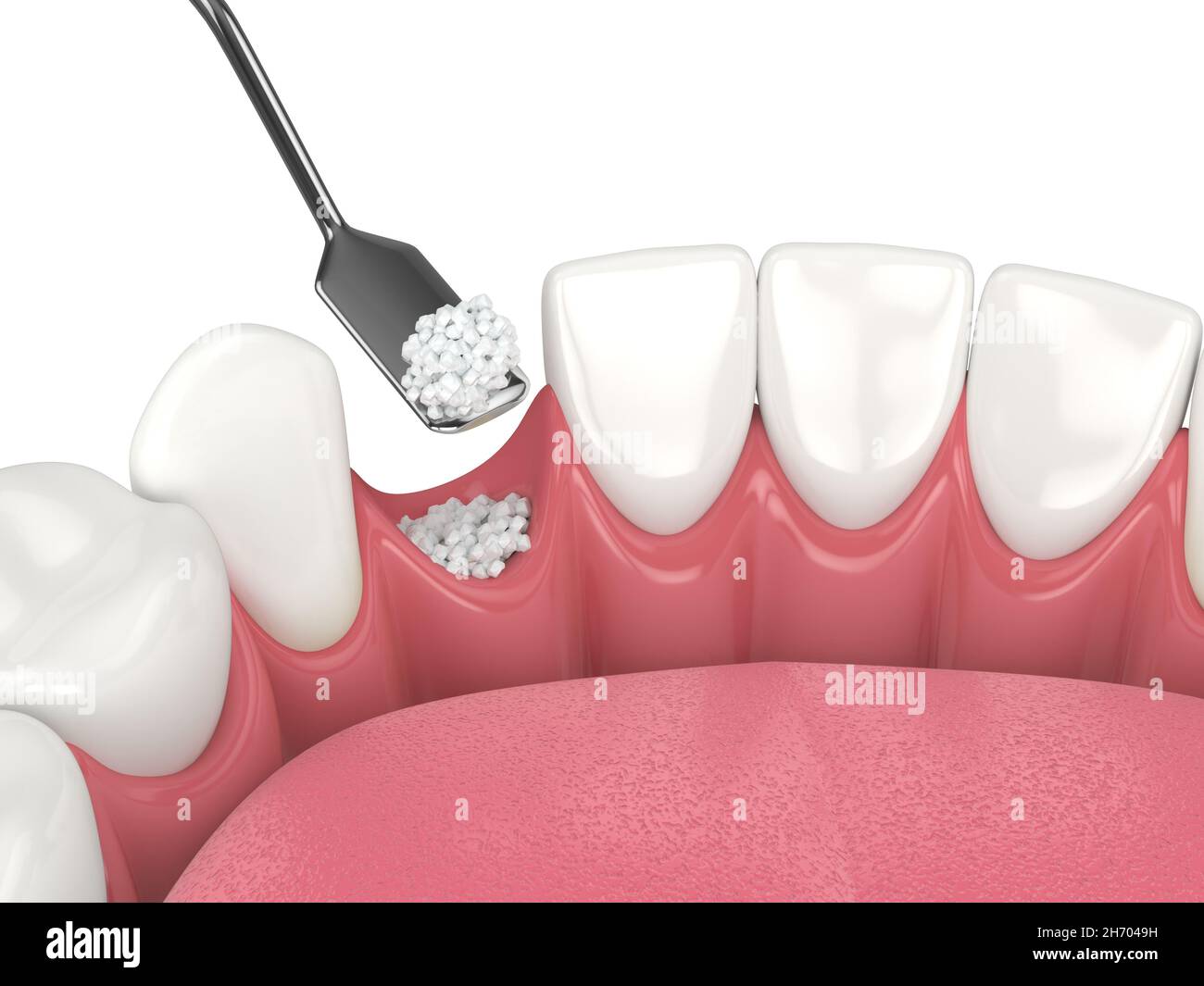 3D render of dental bone grafting with dental bone biomaterial over ...
