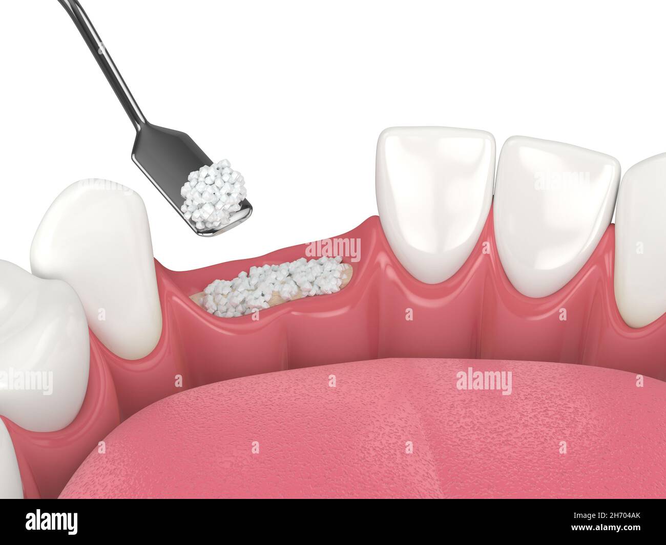 3D render of dental bone grafting with dental bone biomaterial over ...