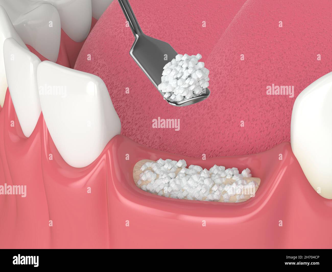 3D render of dental bone grafting with dental bone biomaterial over ...
