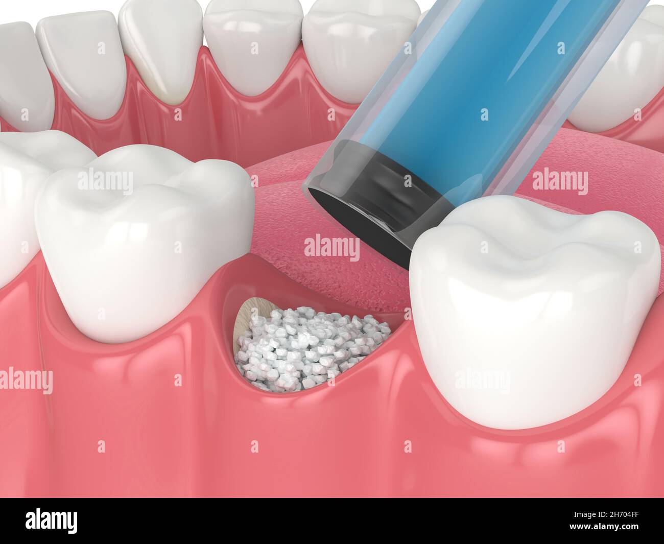 3D render of dental bone grafting with dental bone biomaterial ...