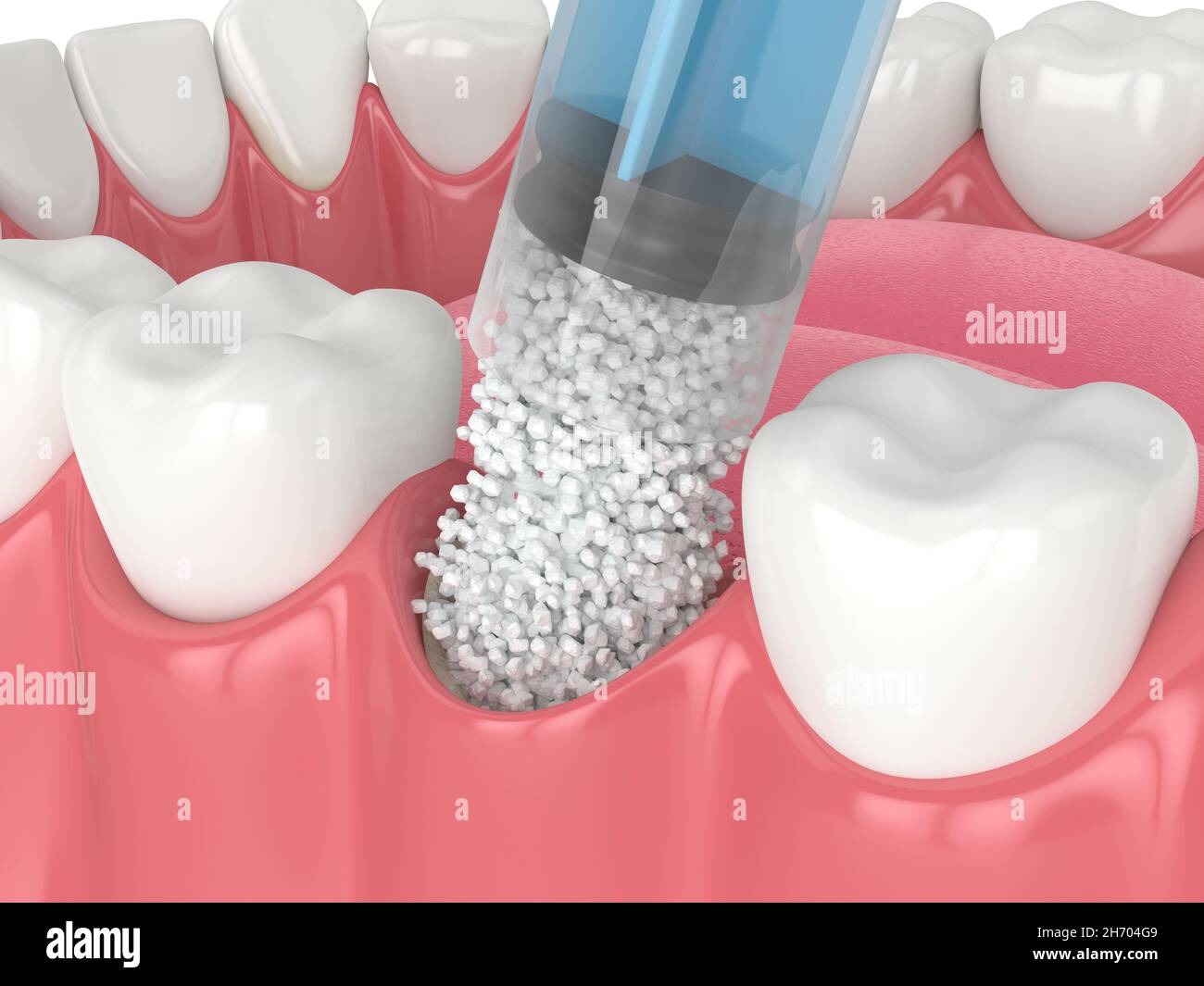 3D render of dental bone grafting with dental bone biomaterial ...