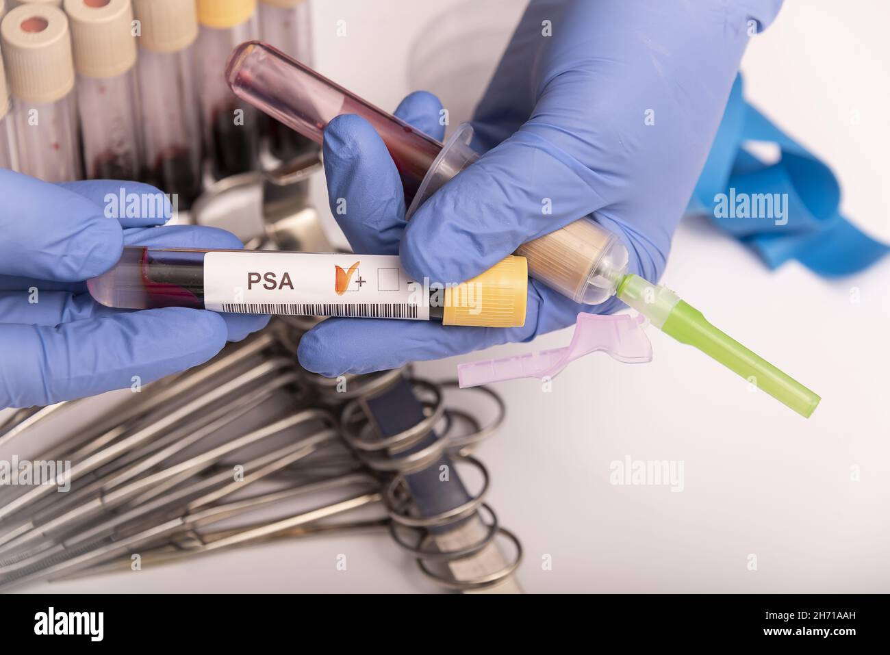Blood sample with abnormal high PSA test result Stock Photo - Alamy