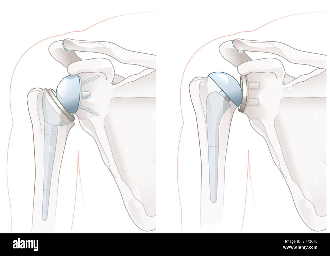 Illustration showing reverse shoulder arthroplasty and total shoulder ...