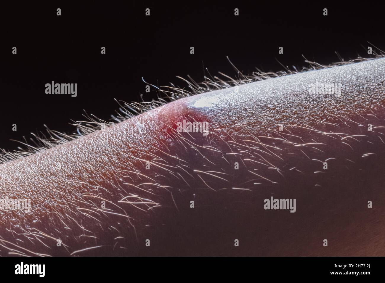 The patient had an abscess on his arm that was scratched by a cat Stock ...