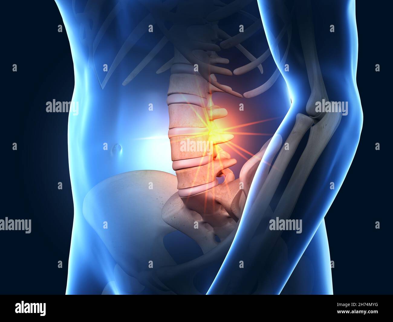 3D illustration showing painful lumbar spine joints, medical 3D ...
