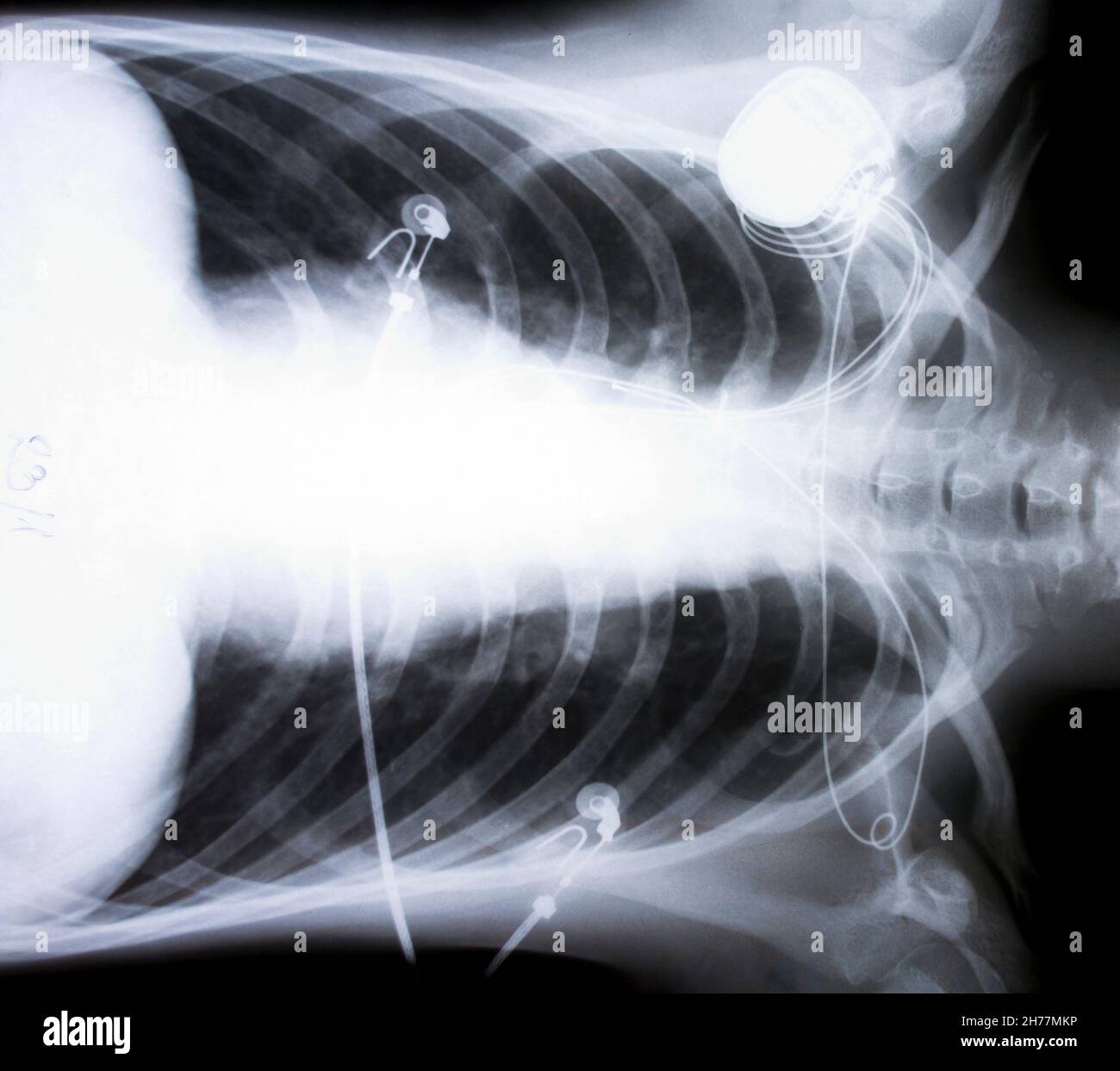 Pacemaker x ray image hi-res stock photography and images - Alamy