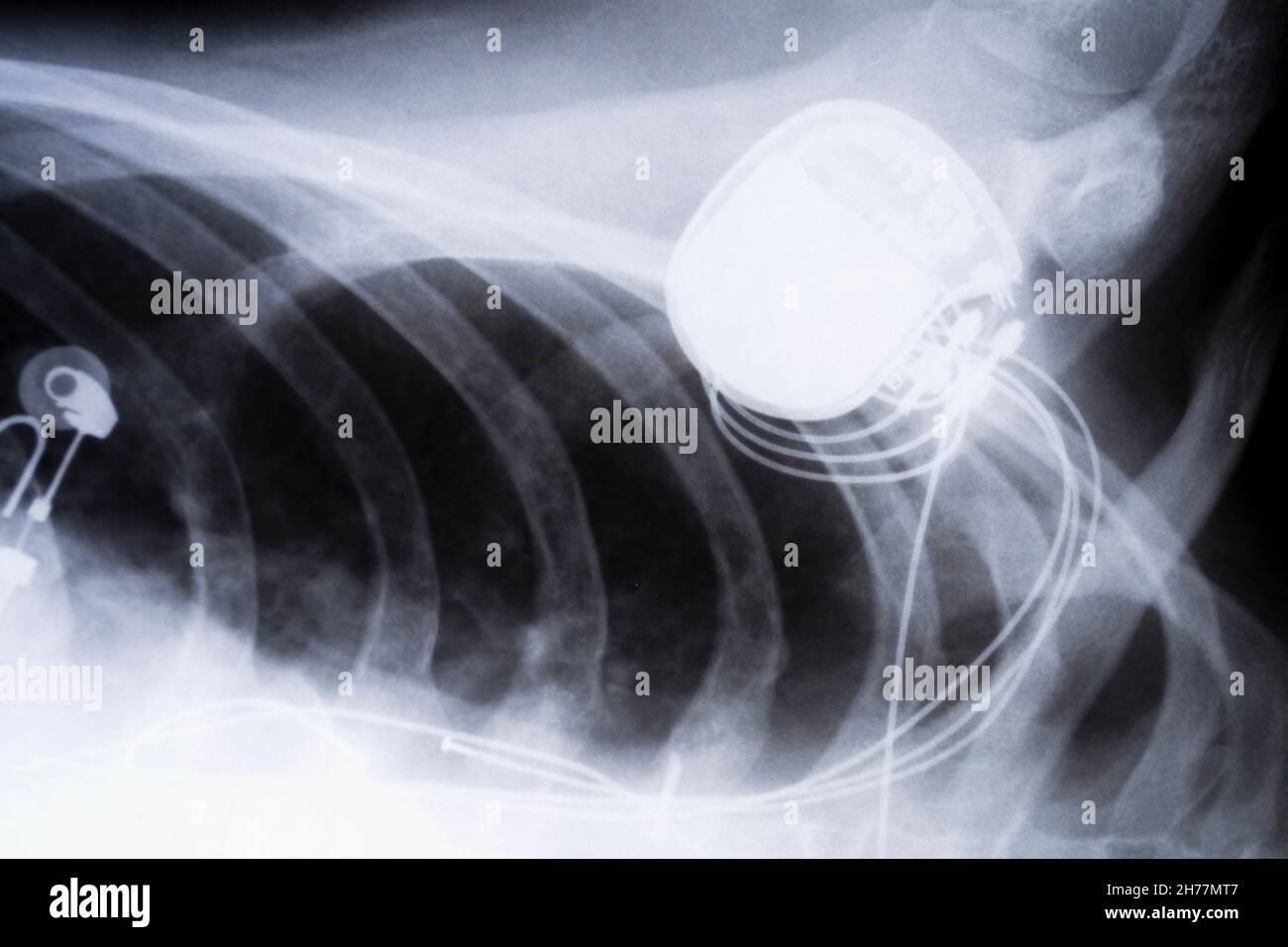 Pacemaker x ray image hi-res stock photography and images - Alamy