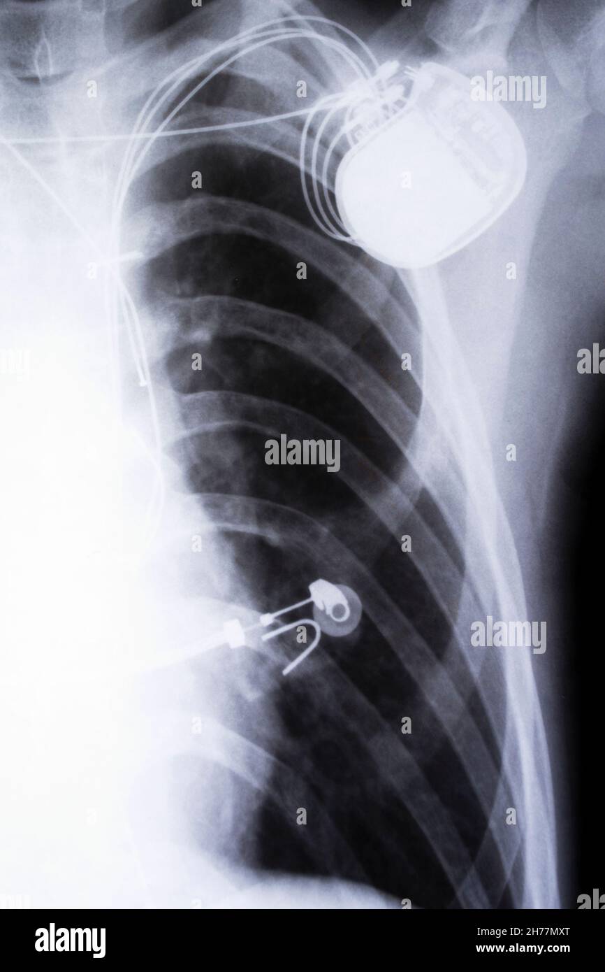 x-ray imagefrom the human chest and pacemaker Stock Photo - Alamy