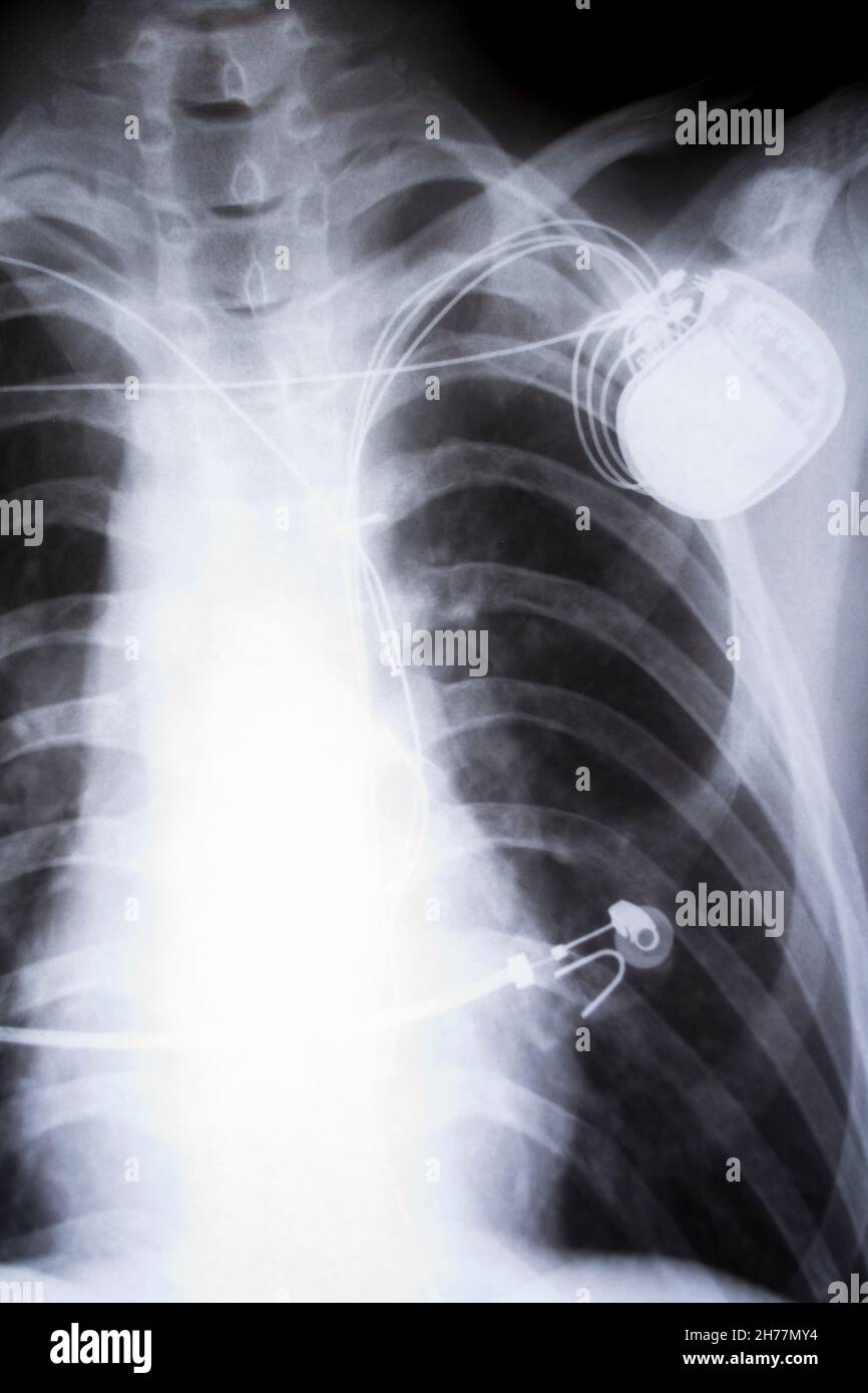 Chest x ray pacemaker hi-res stock photography and images - Alamy