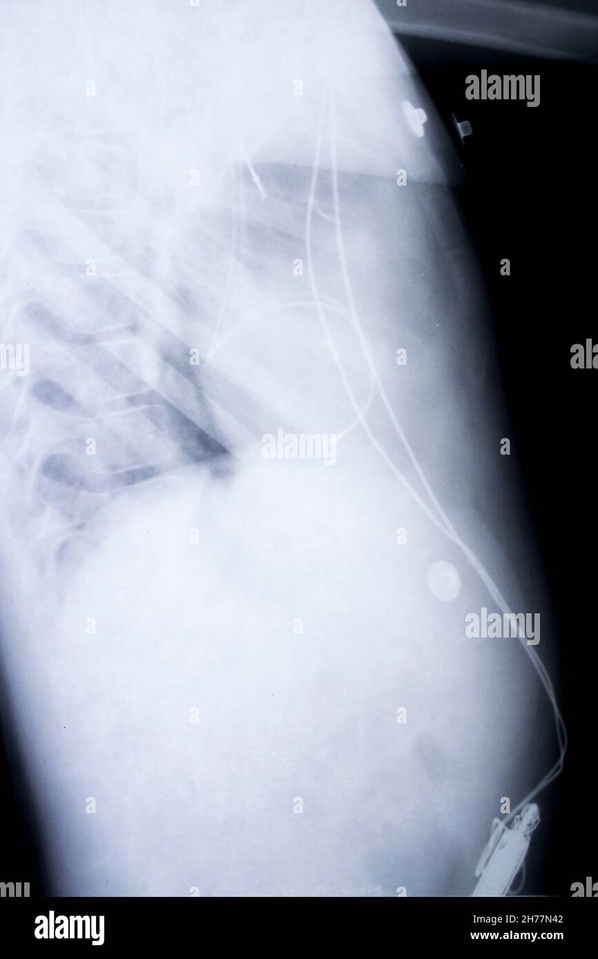 x-ray imagefrom the human chest and pacemaker Stock Photo - Alamy