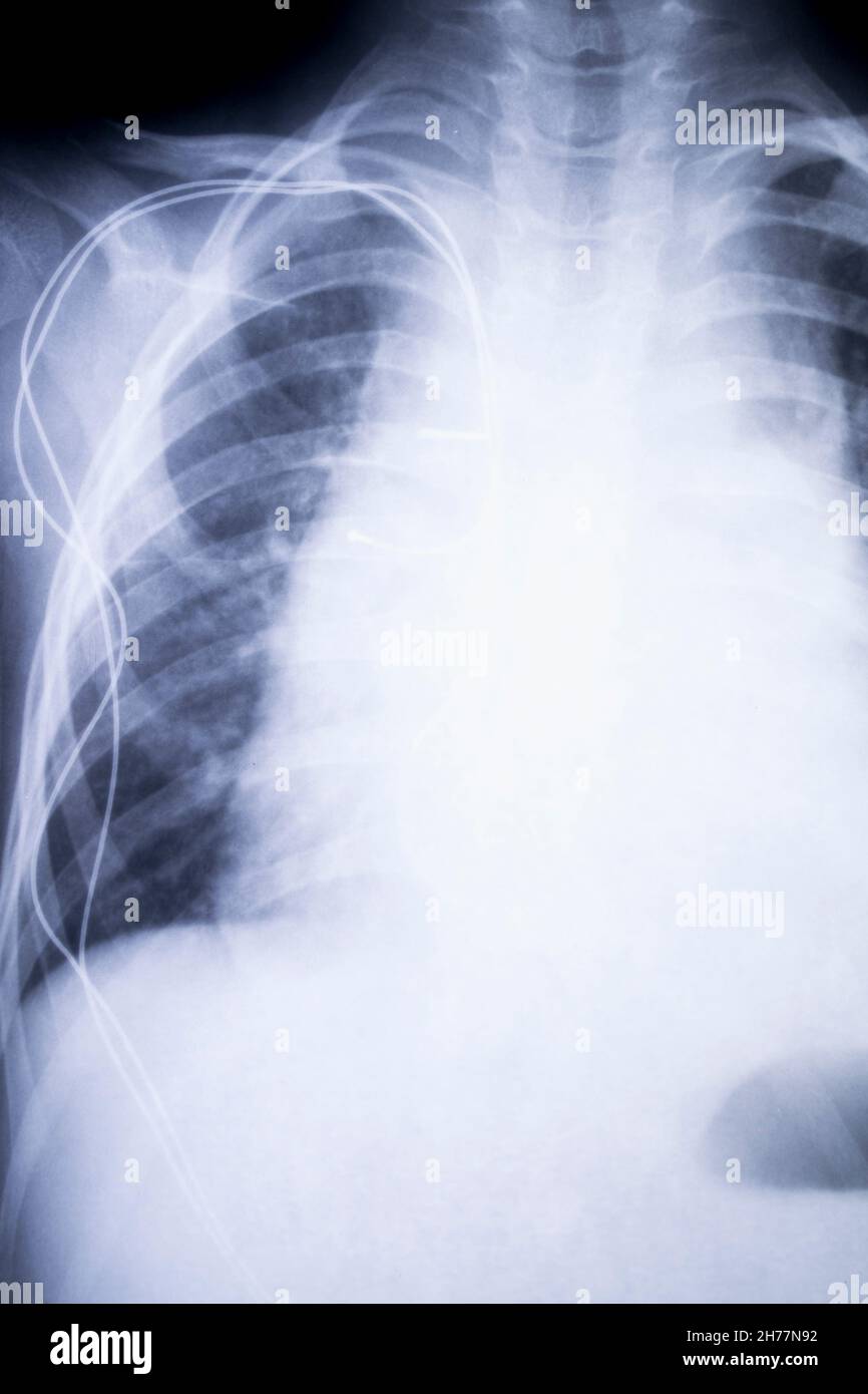 x-ray imagefrom the human chest and pacemaker Stock Photo - Alamy