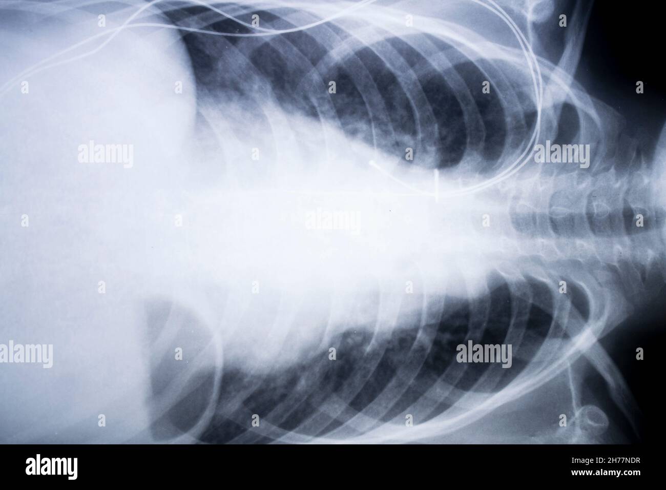 Chest x ray pacemaker hi-res stock photography and images - Alamy