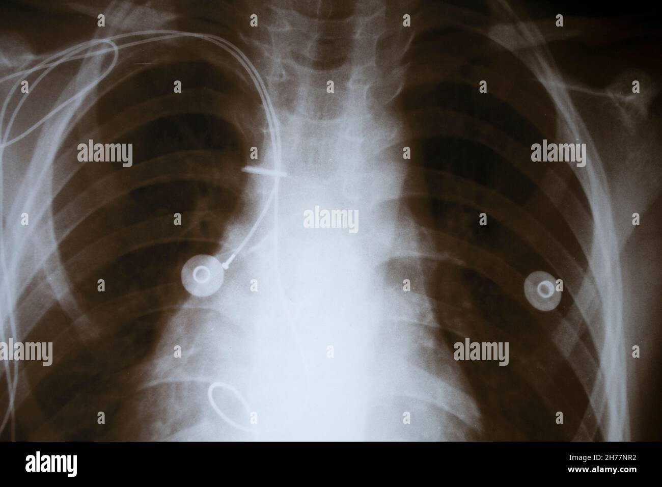 Chest x ray pacemaker hi-res stock photography and images - Alamy